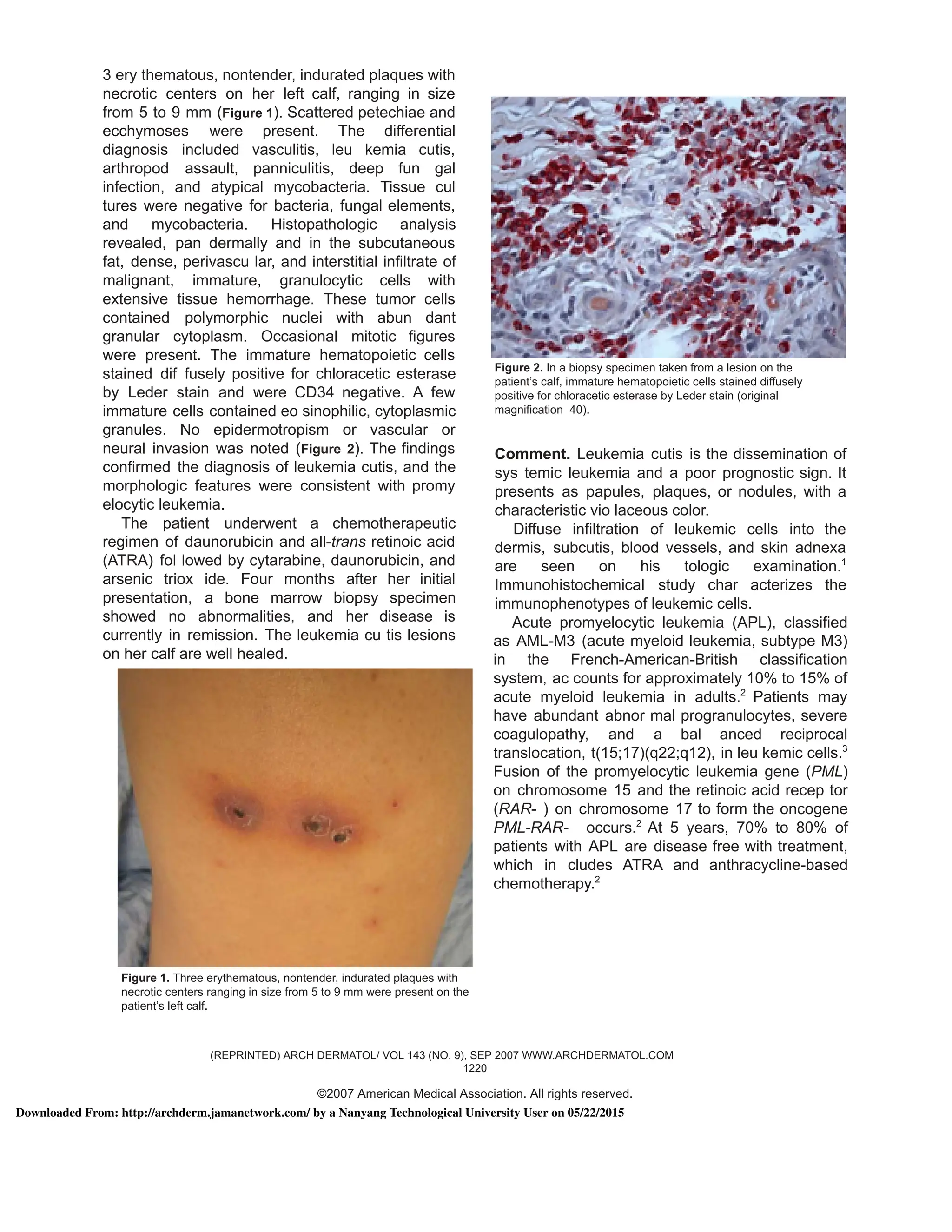 Successful Treatment of Pityriasis Versicolor.pdf