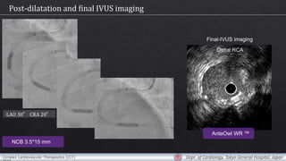 Successful Two-Staged PCI for Double Chronic Total Occlusions of the ...