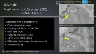Successful Two-Staged PCI for Double Chronic Total Occlusions of the ...