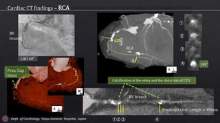 Successful Two-Staged PCI for Double Chronic Total Occlusions of the ...