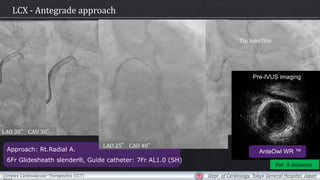 Successful Two-Staged PCI for Double Chronic Total Occlusions of the Ostial LCX and Completely ...