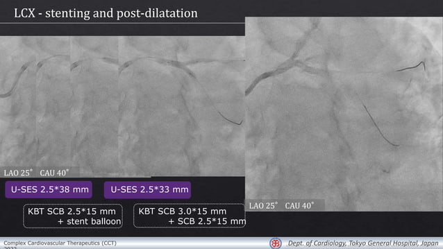 Successful Two-Staged PCI for Double Chronic Total Occlusions of the ...