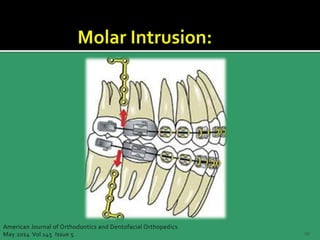 Success rate of miniplate anchorage for bone anchored maxillary protraction | PPTX