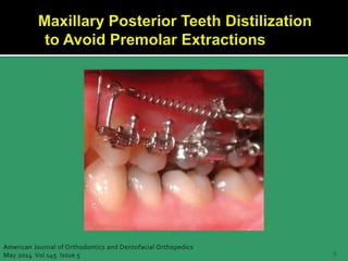 Success rate of miniplate anchorage for bone anchored maxillary protraction | PPTX
