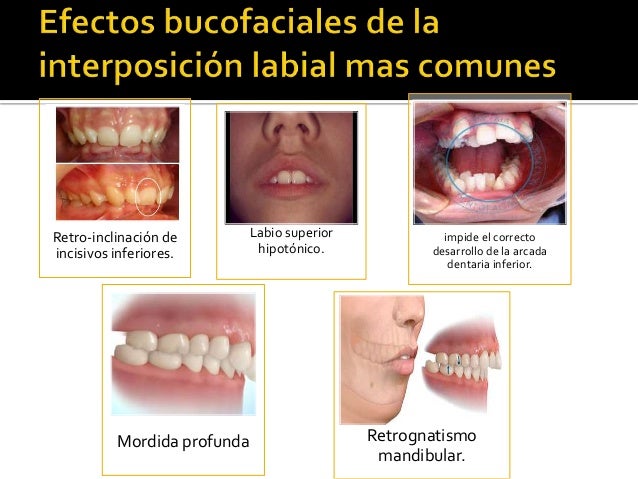 Hábito de Succión Labial