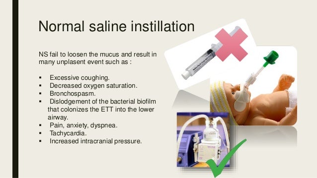 Suctioning -neonates-