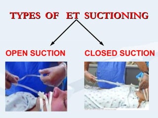 Endotracheal Tube Suctioning