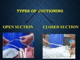 Suction therapy for ICU Patients | PPT
