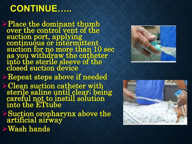 Suction therapy for ICU Patients | PPT