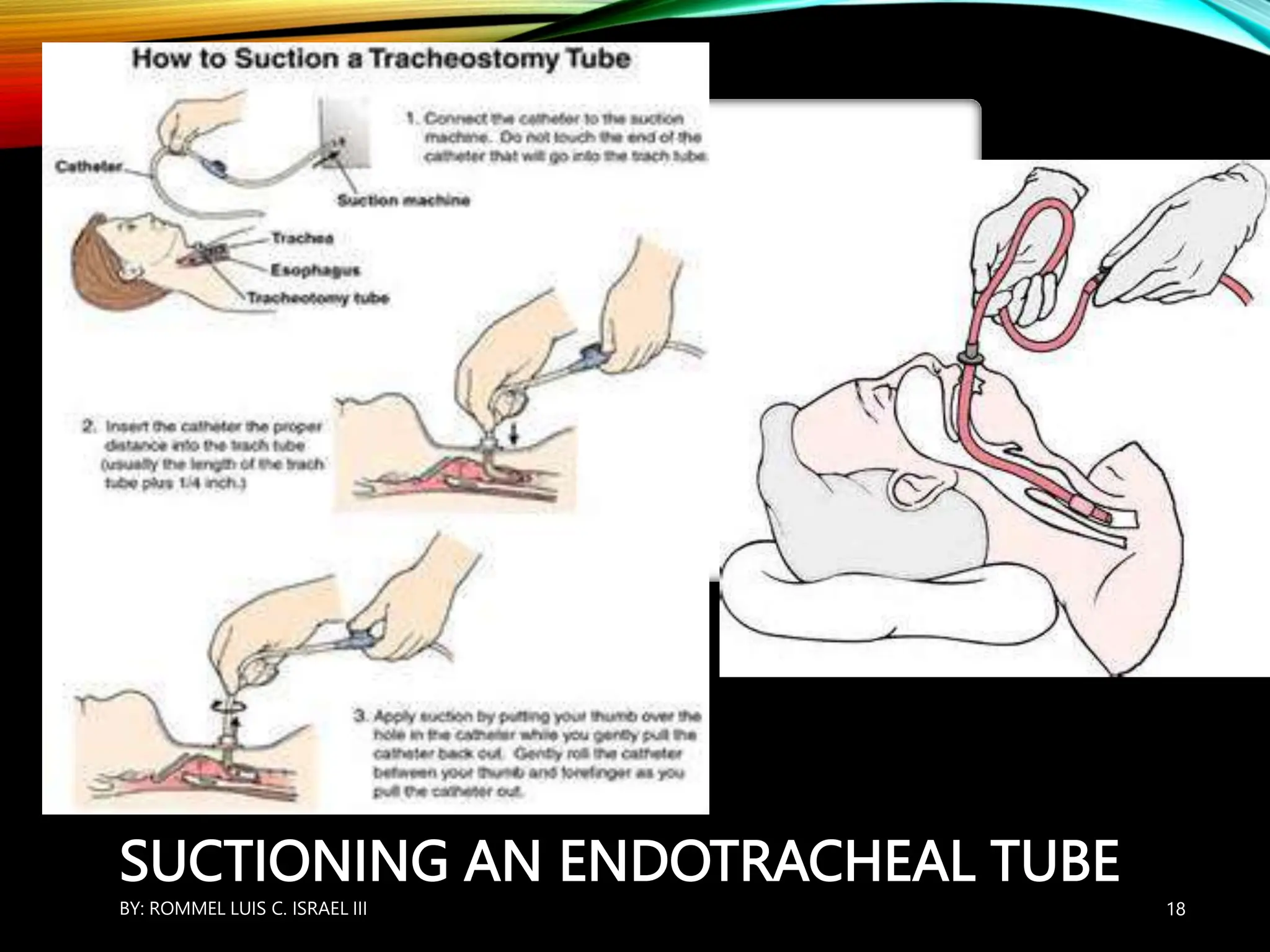 SUCTIONING OROPHARYNGEAL AND NASOPHARYNGEAL CAVITIES | PPTX