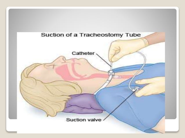 suctioningprocedureppt-221006121029-.pdf | Lung and Respiratory Health ...
