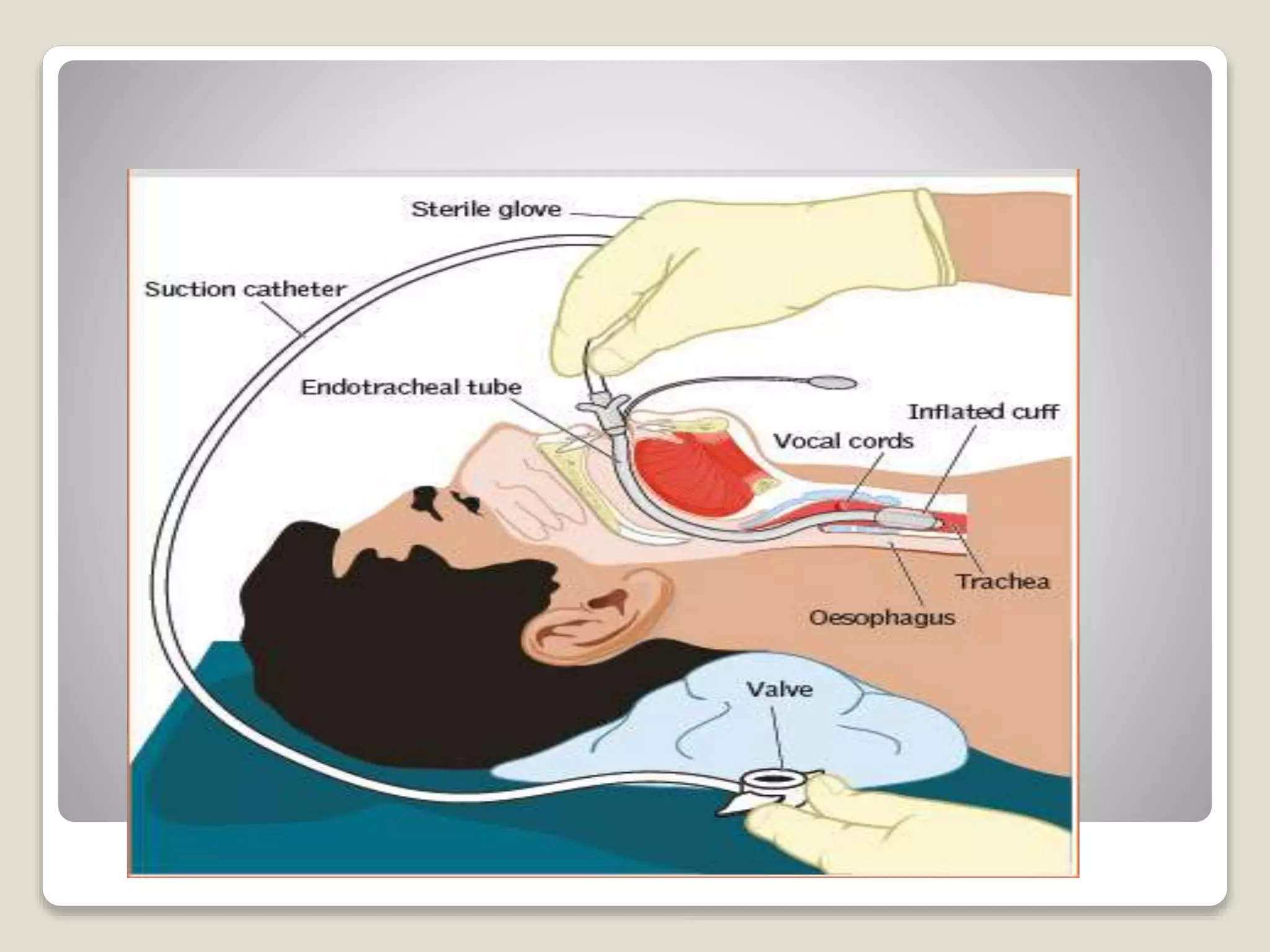 suctioning procedure ppt.pptx