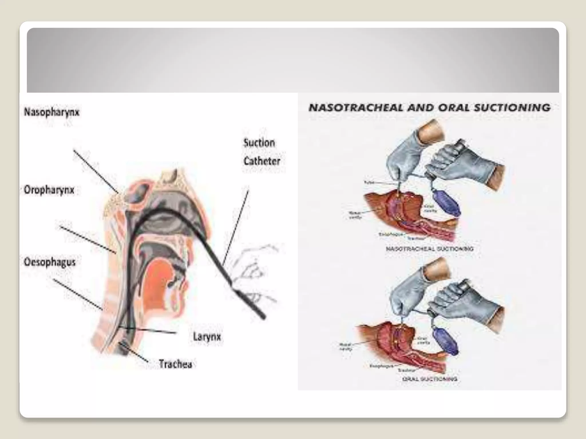 suctioning procedure ppt.pptx