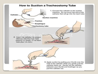 Tracheostomy Tube Suctioning