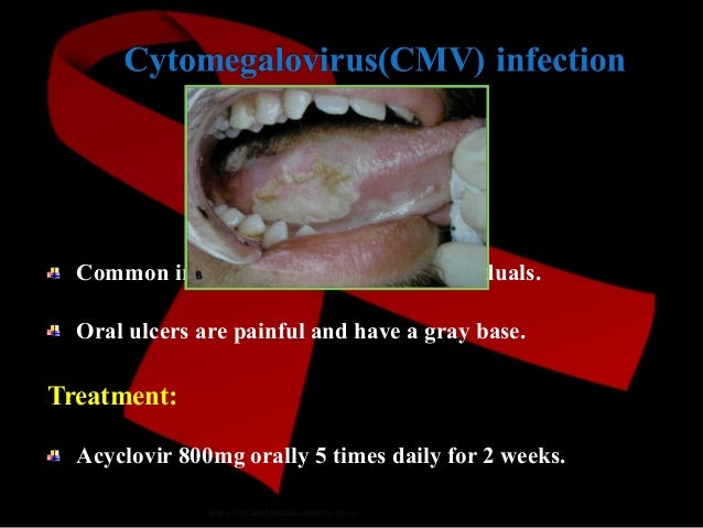 ORAL HEALTH CONCEPTS IN HIV PATIENTS