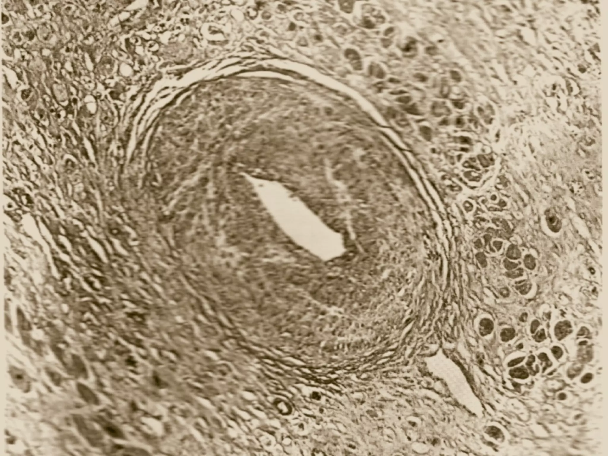 Sudden cardiac death | PPT | Heart and Cardiovascular Diseases ...