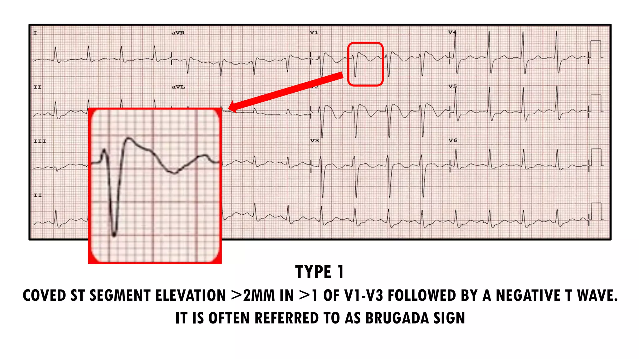 SUDDEN CARDIAC DEATH@.pdf