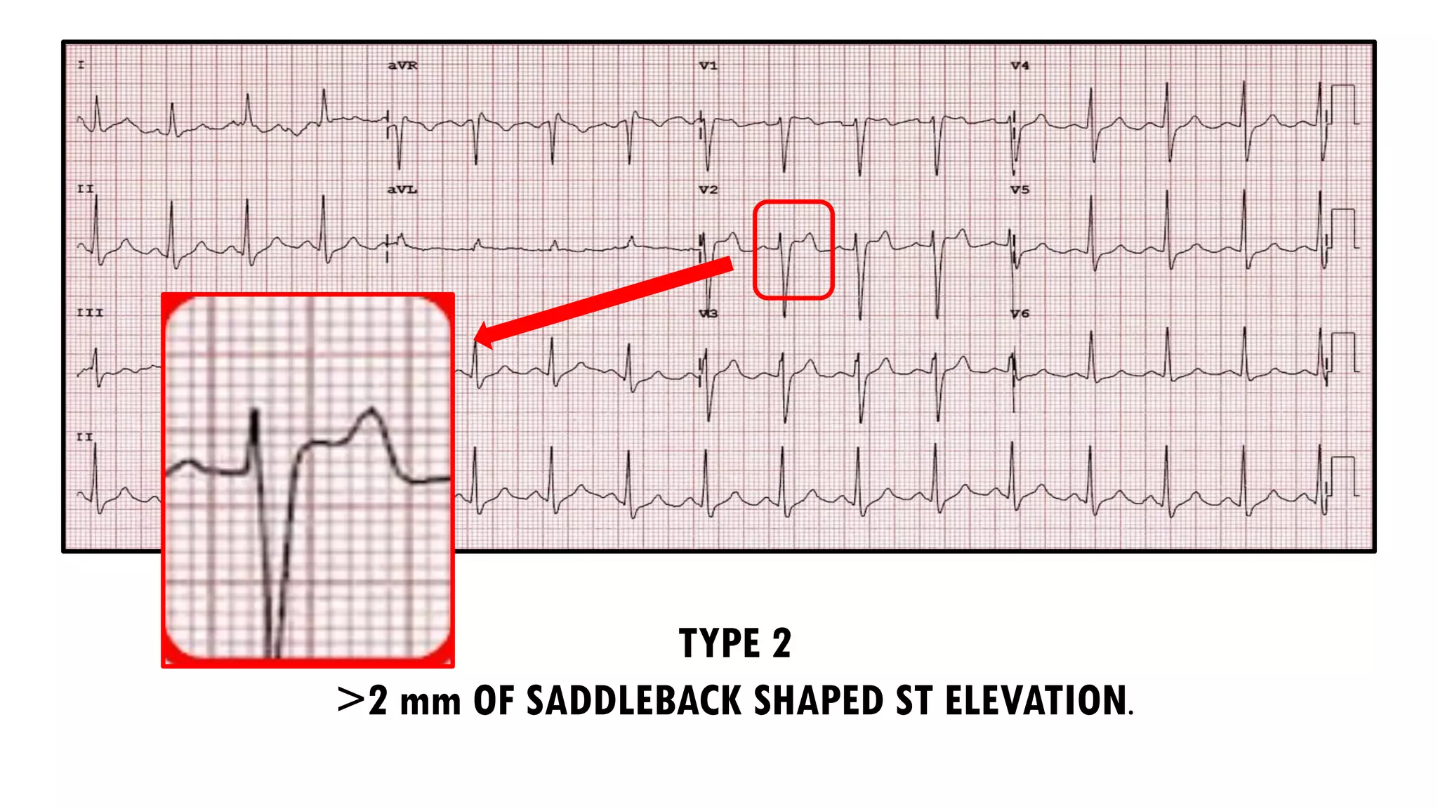 SUDDEN CARDIAC DEATH@.pdf