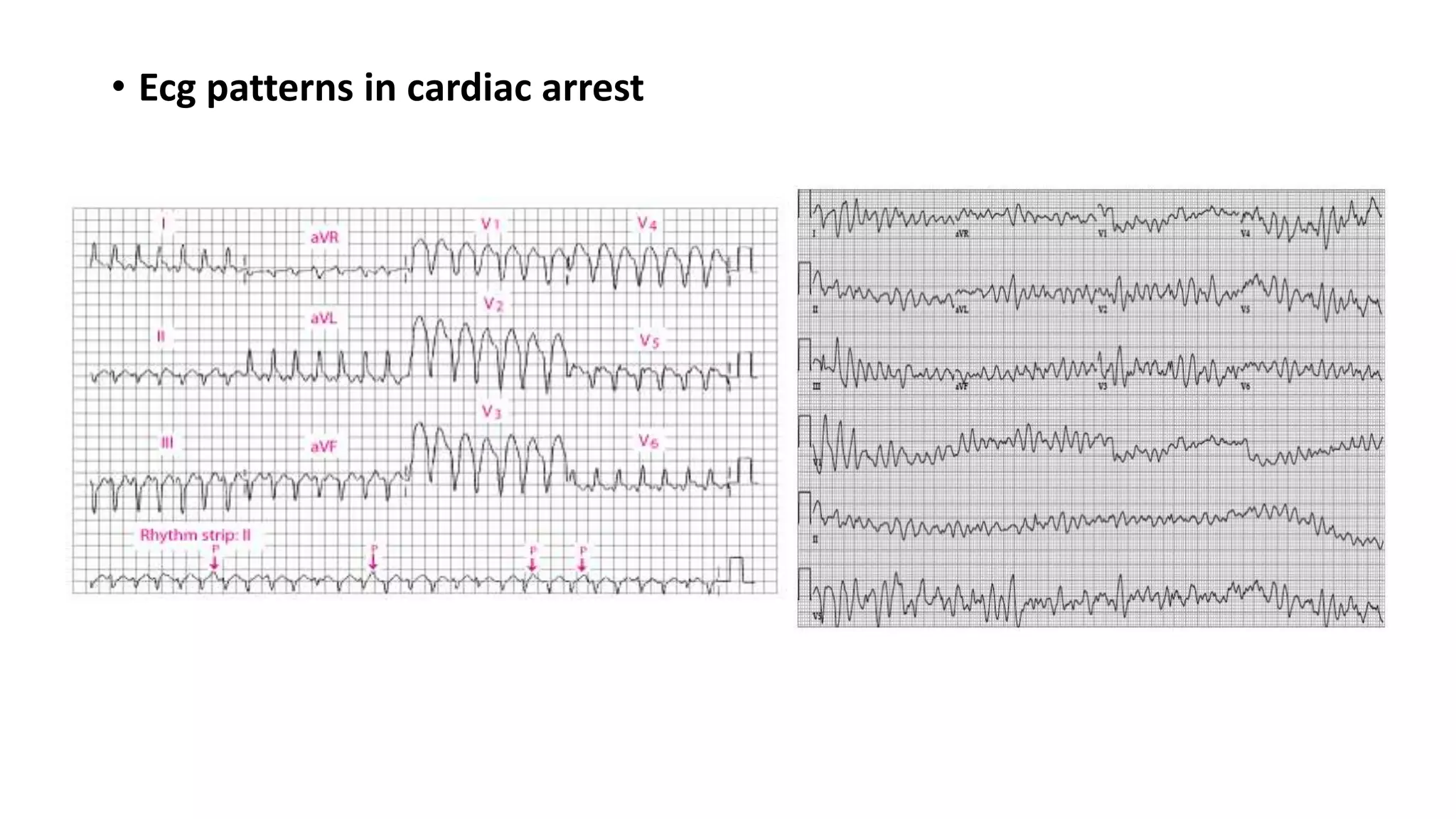 Sudden cardiac death | PPTX