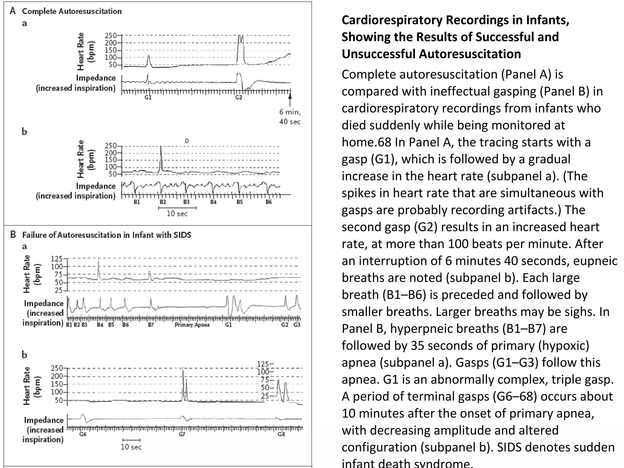 Sudden Infant Death Syndrome | PPT