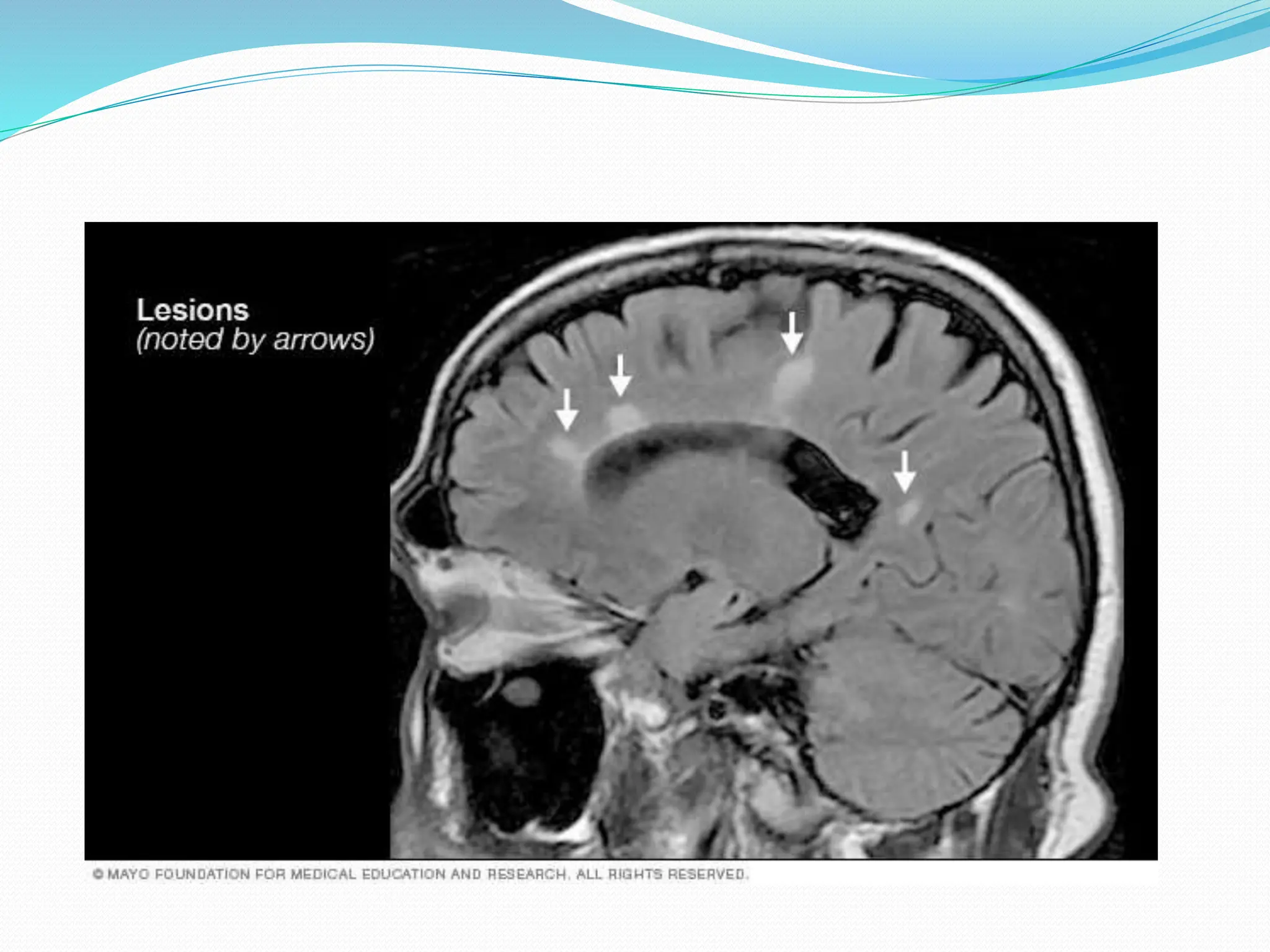 Sudden Loss of Vision Differential Diagnosis | PPT
