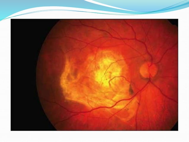 Sudden Loss of Vision Differential Diagnosis | PPT