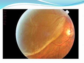 Sudden Loss of Vision Differential Diagnosis | PPT