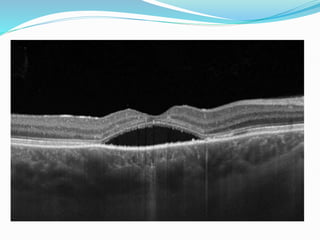 Sudden Loss of Vision Differential Diagnosis | PPT