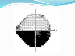 Sudden Loss of Vision Differential Diagnosis | PPTX
