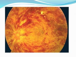 Sudden Loss of Vision Differential Diagnosis | PPT