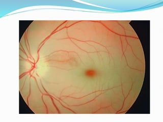 Sudden Loss of Vision Differential Diagnosis | PPTX