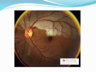 Sudden Loss of Vision Differential Diagnosis | PPTX
