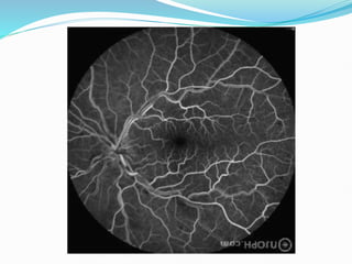 Sudden Loss of Vision Differential Diagnosis | PPT