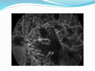 Sudden Loss of Vision Differential Diagnosis | PPTX