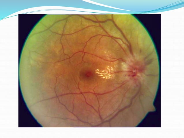 Sudden Loss of Vision Differential Diagnosis | PPT