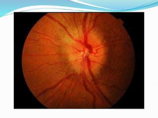 Sudden Loss of Vision Differential Diagnosis | PPT