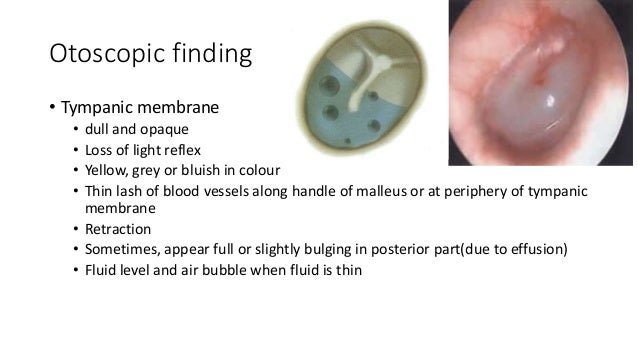 Sudden sensory neural hearing loss