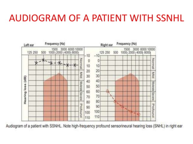 Sudden SNHL | PPTX | Ear, Nose and Throat Conditions | Diseases and ...