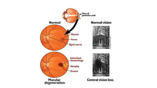 Sudden Visual Loss | PDF