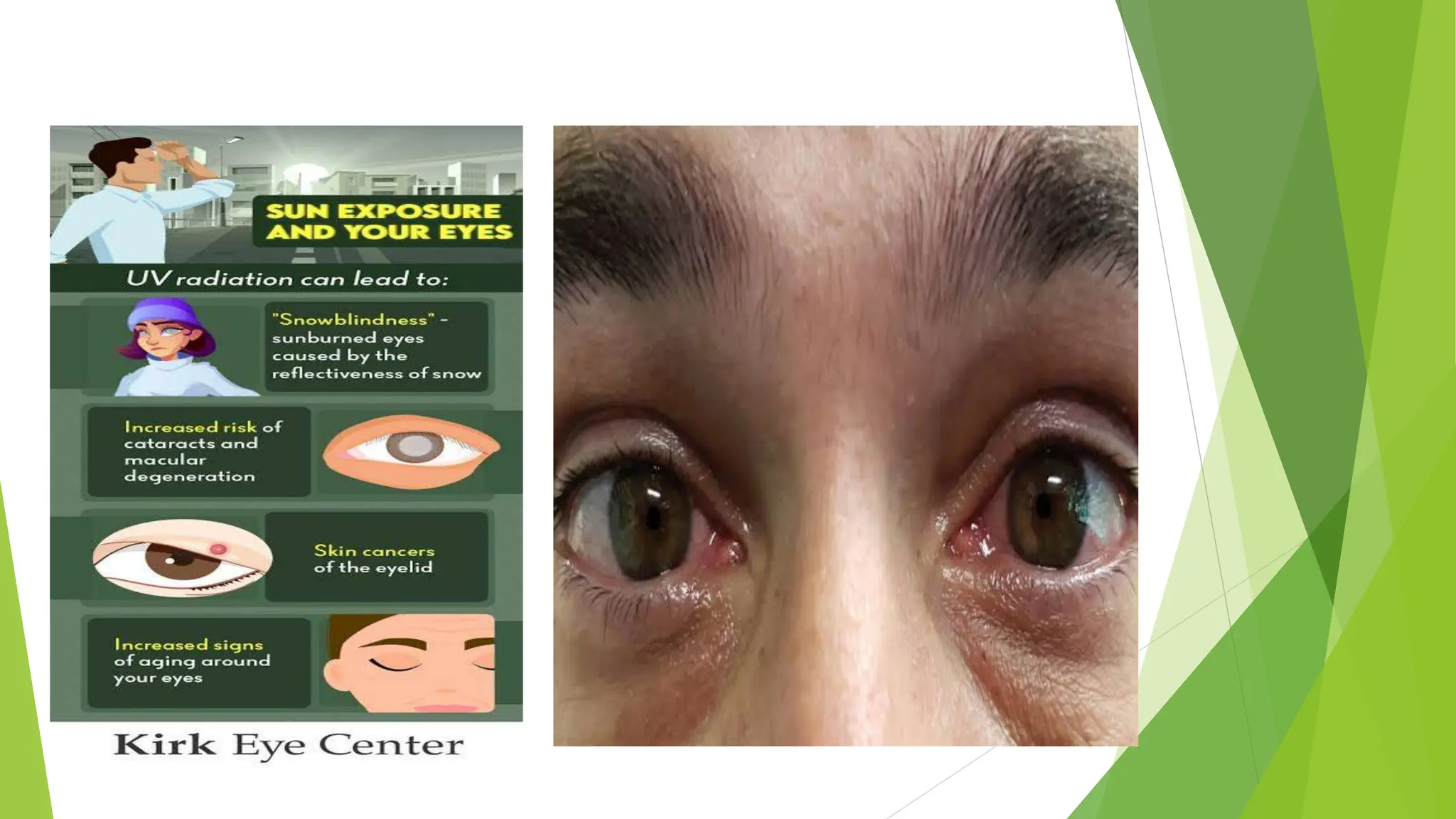 PPT ON ELECTROMAGNETIC RADIATION AND ITS EFFECT ON EYES | PPT