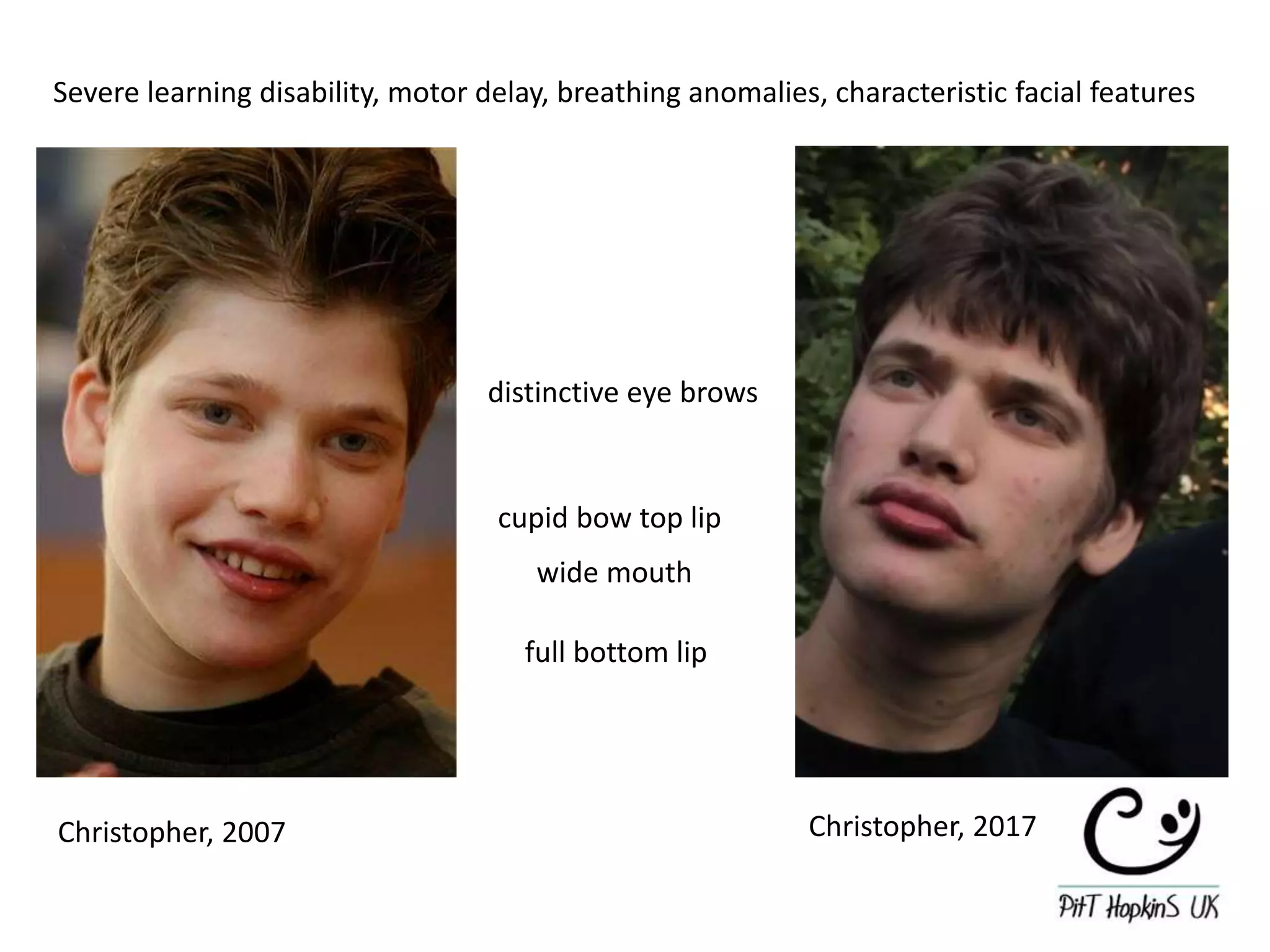 Sue Routledge pitt hopkins syndrome uk crdn summit 2017 | PPT