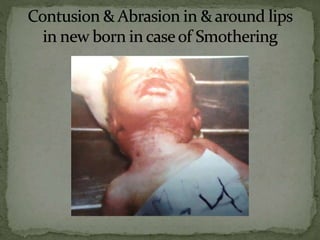 suffocation.pptx