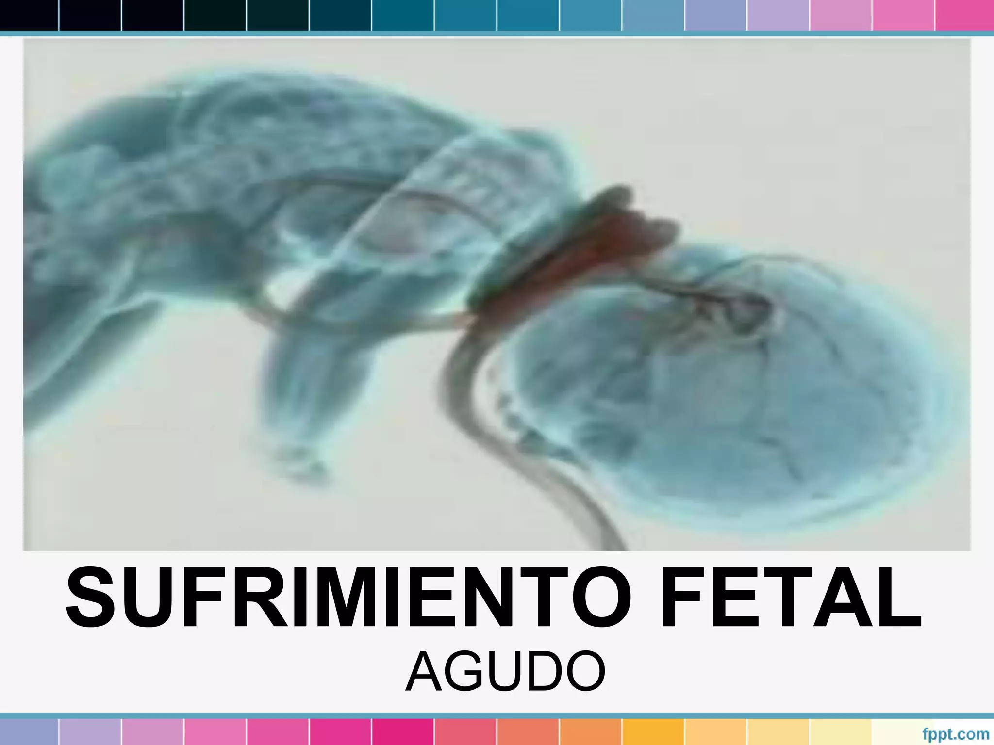 Sufrimiento fetal agudo | PPTX
