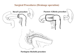 Sugery for chronic pancreatitis.dr quiyum | PPTX