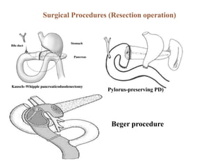 Sugery for chronic pancreatitis.dr quiyum | PPTX