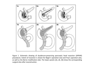 Sugery for chronic pancreatitis.dr quiyum | PPTX