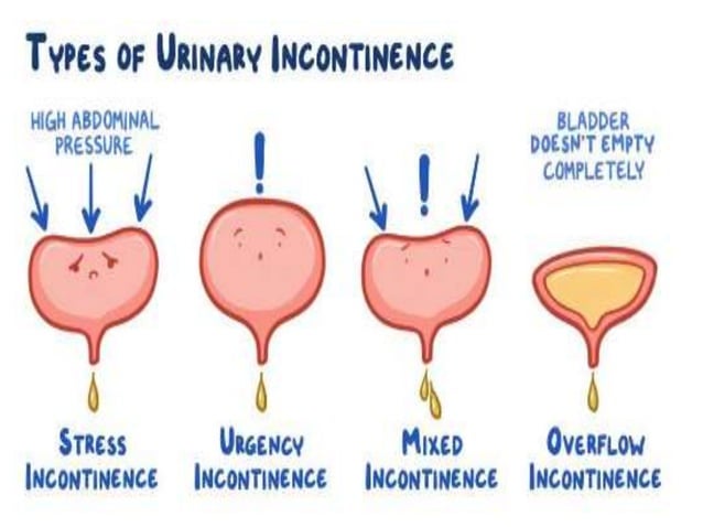 Stress Urinary Incontinence (SUI) : Dr Sharda Jain | PPTX