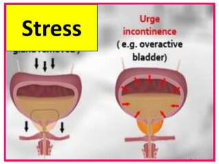 Stress Urinary Incontinence (SUI) : Dr Sharda Jain | PPTX