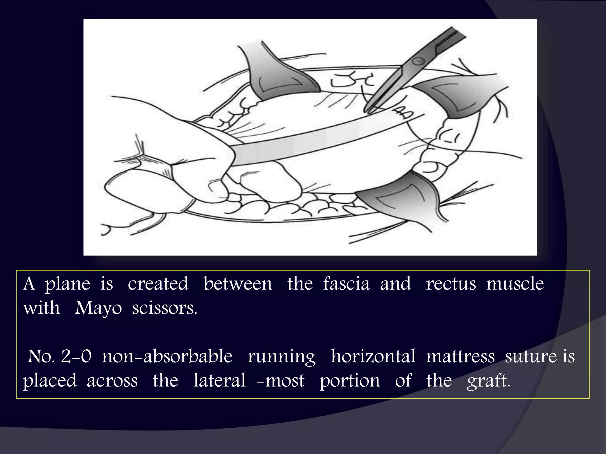 Vaginal approach for Stress Urinary Incontinence surgery | PPT