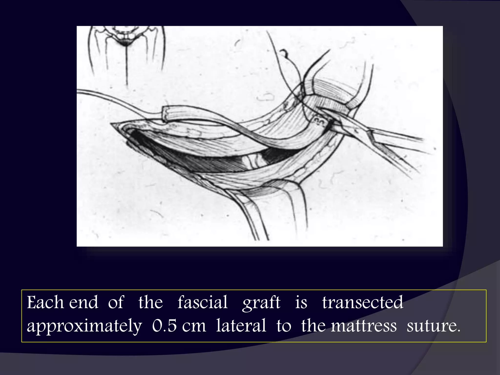 Vaginal approach for Stress Urinary Incontinence surgery | PPT